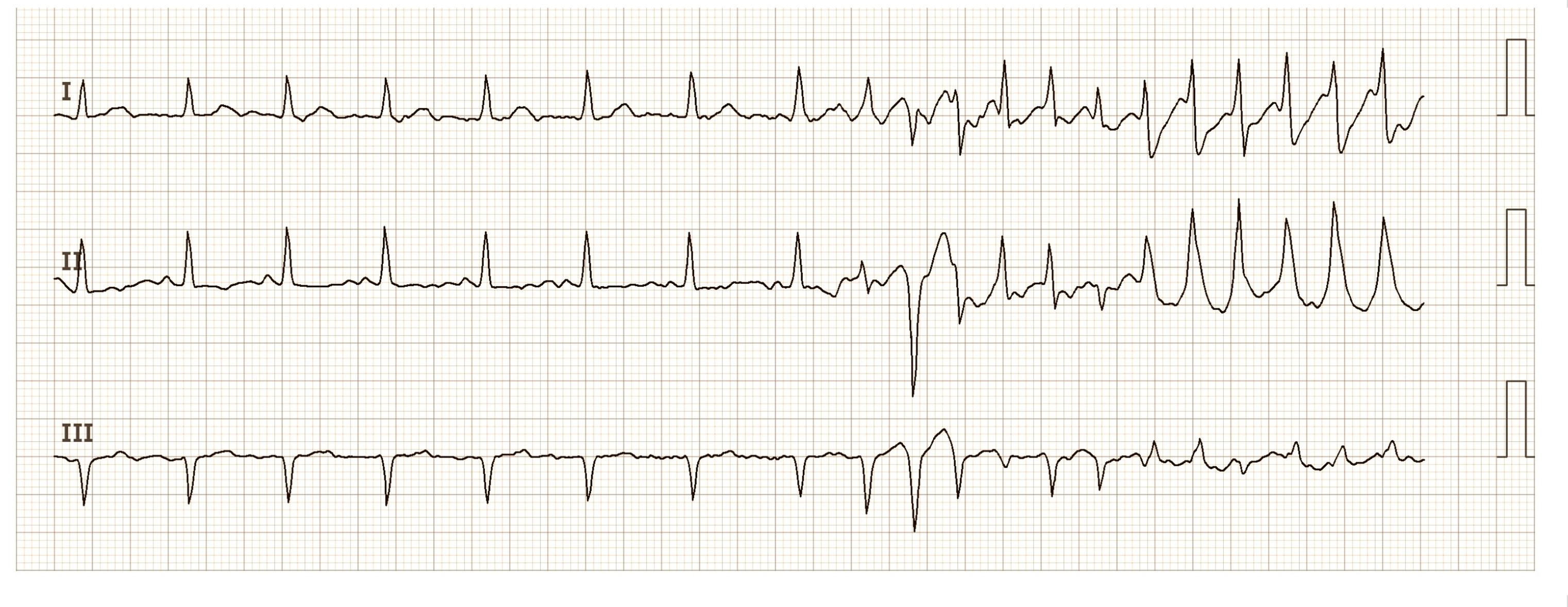 Polymorphic ventricular tachycardia | ECG Guru - Instructor Resources Polymorphic ventricular tachycardia | ECG Guru - Instructor Resources